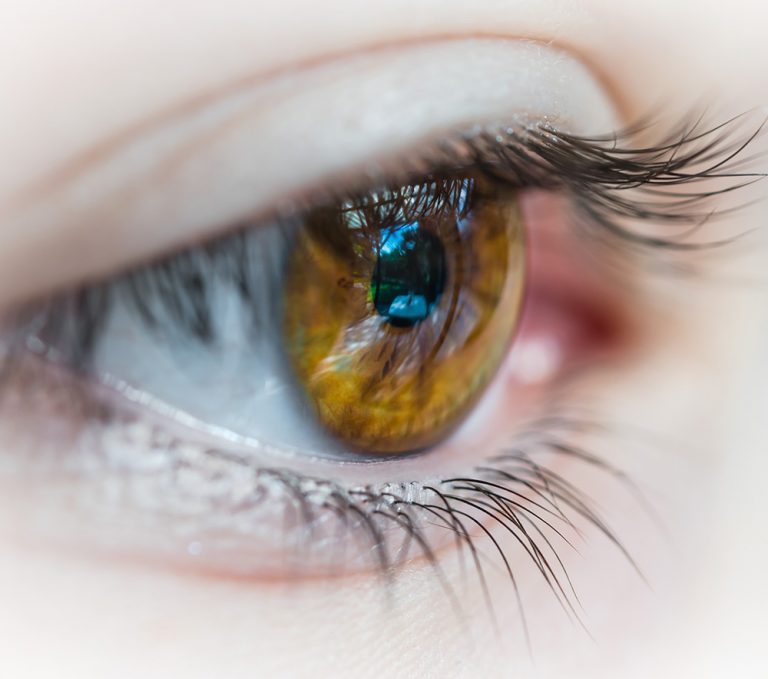 Queratocono tratamiento | Oftalmedic | Oftalmólogos Palma